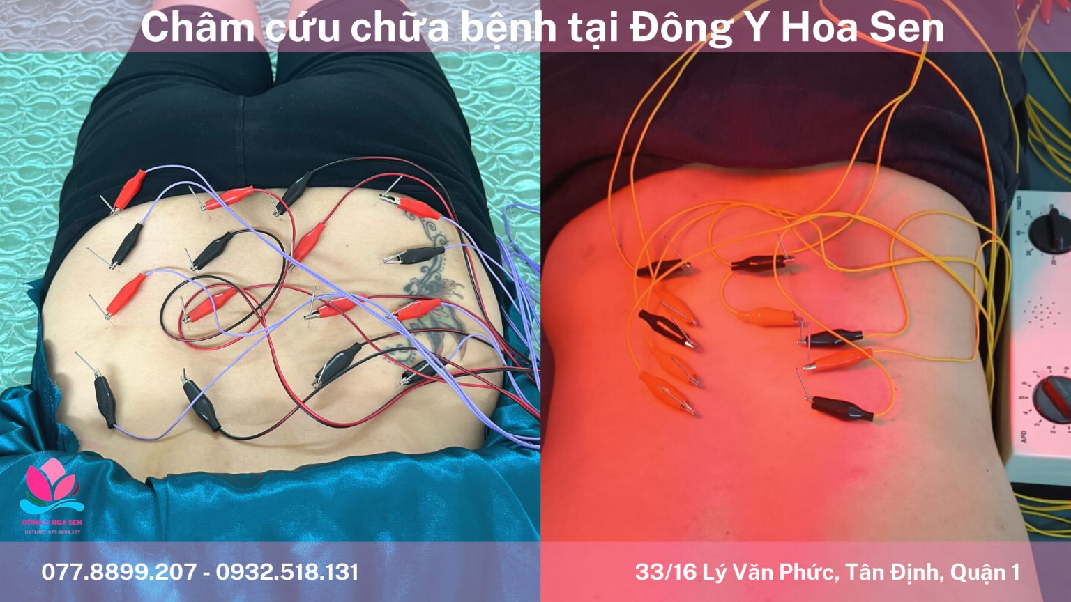 Châm cứu đau vai gáy chất lượng tại Đông Y Hoa Sen